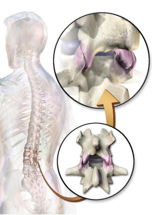 CPT Coding for Paravertebral Facet Joint Injections – the Impact of ...