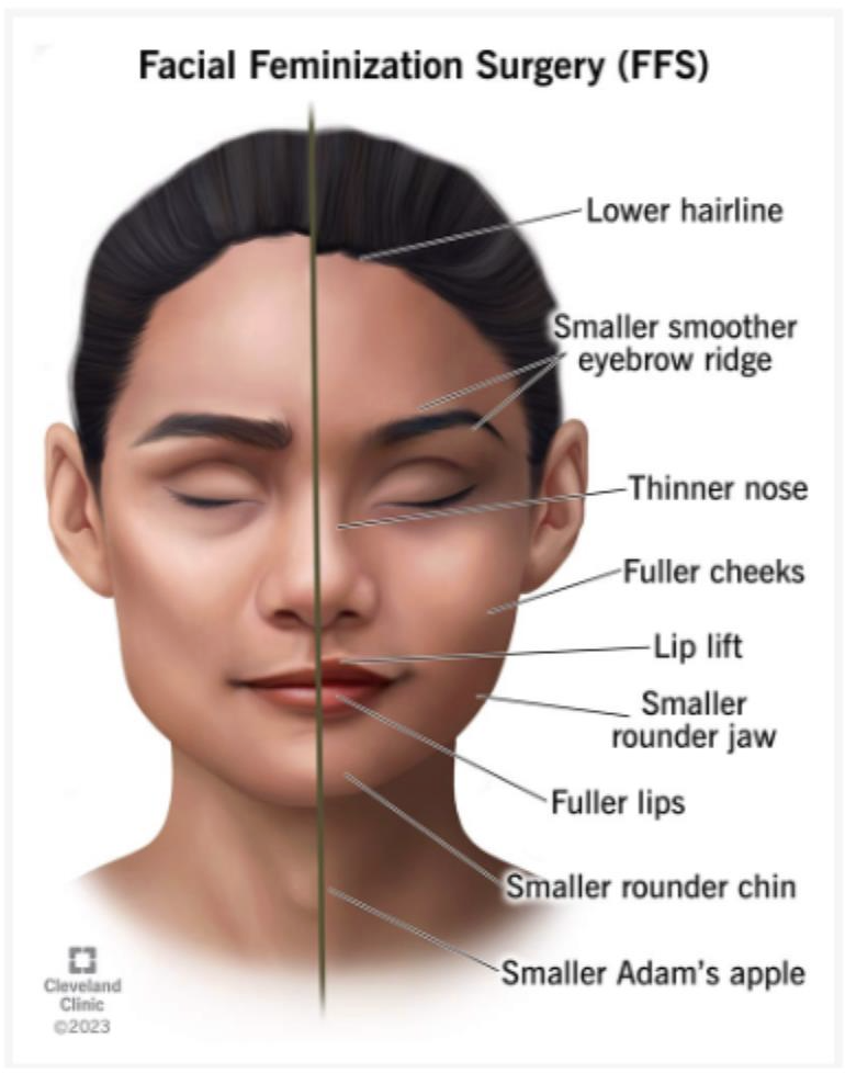 Facial Feminization Surgery Coding for Gender Reassignment