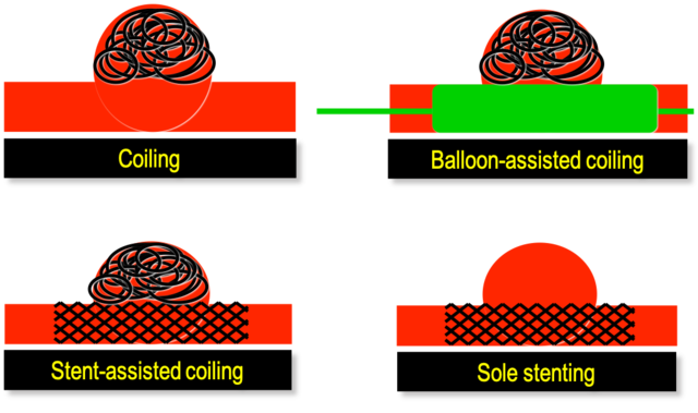 ICD-10-PCS Root Operation Selection For Treatment of Cerebral Aneurysms