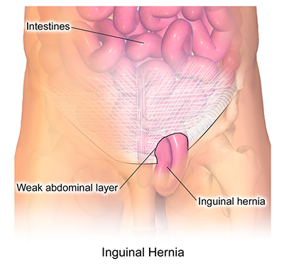 CPT Coding for Open Inguinal Hernia Repair