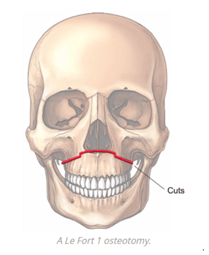 CPT Coding for LeFort I Procedures