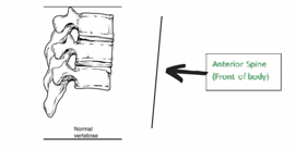 Posterior Spinal Fusion with Anterior Spinal Fusion