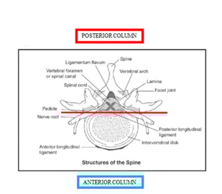 Posterior Spinal Fusion with Anterior Spinal Fusion