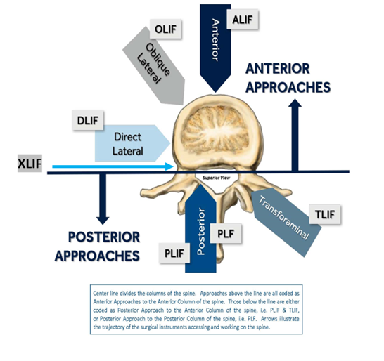 Spinal Fusion Coding: Identifying the Approach Being Used for Fusion