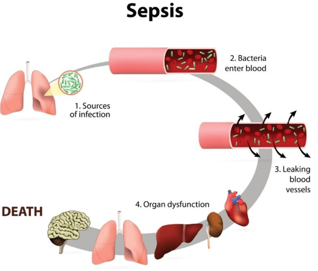 Querying for Sepsis: Clinical Indicators, SOFA Criteria, and How to ...
