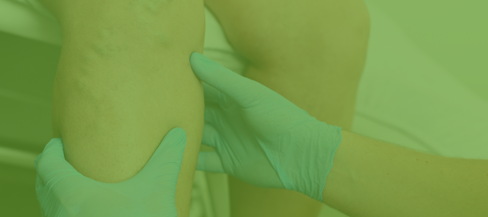 Peripheral Vascular Disease Coding in ICD-10-CM eBook